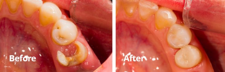 Dental Fillings: Amalgam, Resin Composite and GIC- Prahran Family Dental